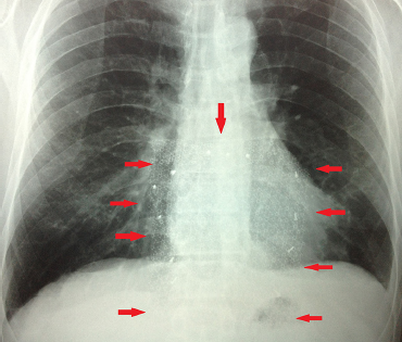 What Is Surgical Mesh? - Owlcation