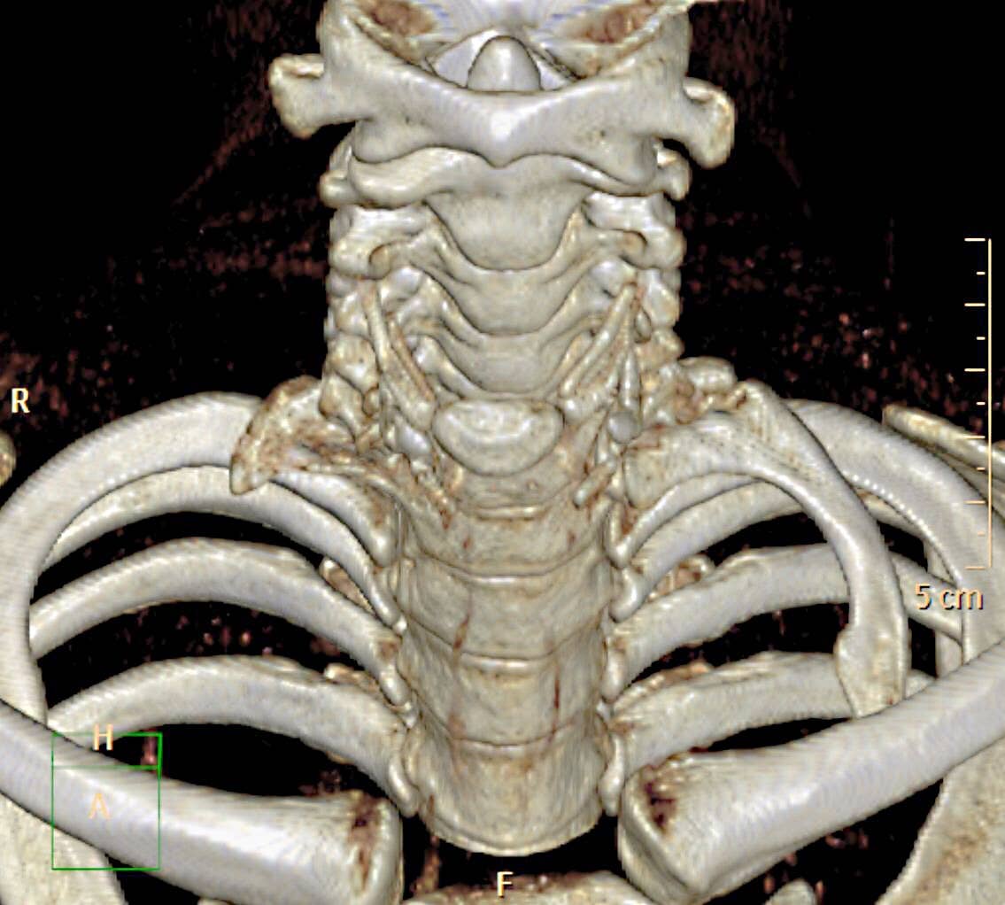 Human Skeleton and Bones: Interesting and Surprising Facts - Owlcation