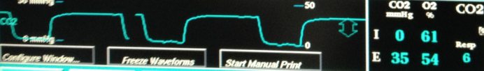 Patient Monitoring During Anesthesia - Owlcation