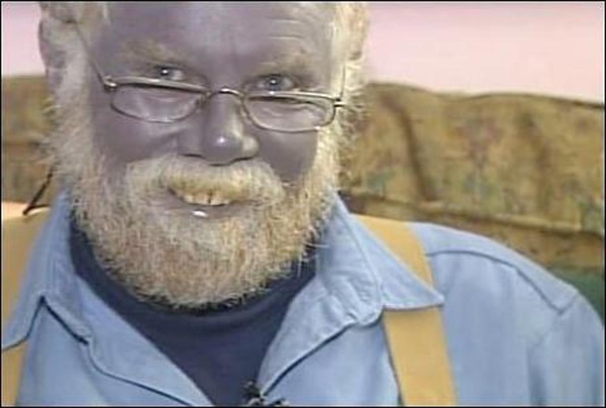 Can Real People Have Blue Skin? - Owlcation