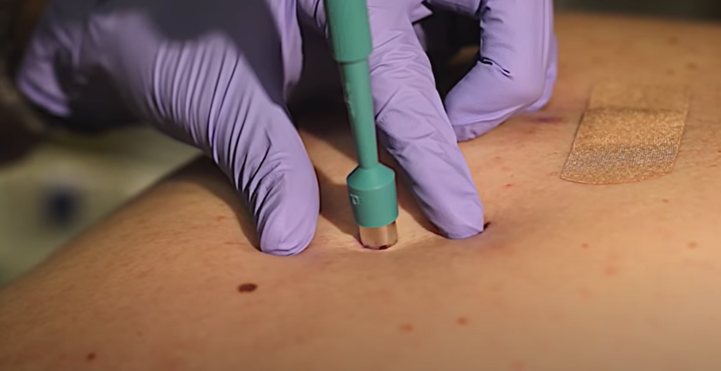 What Happens to a Biopsy After Surgery? - Owlcation