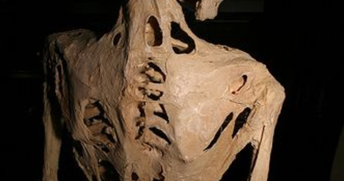 4 Odd Historical Cases of Medical Mystery - Owlcation