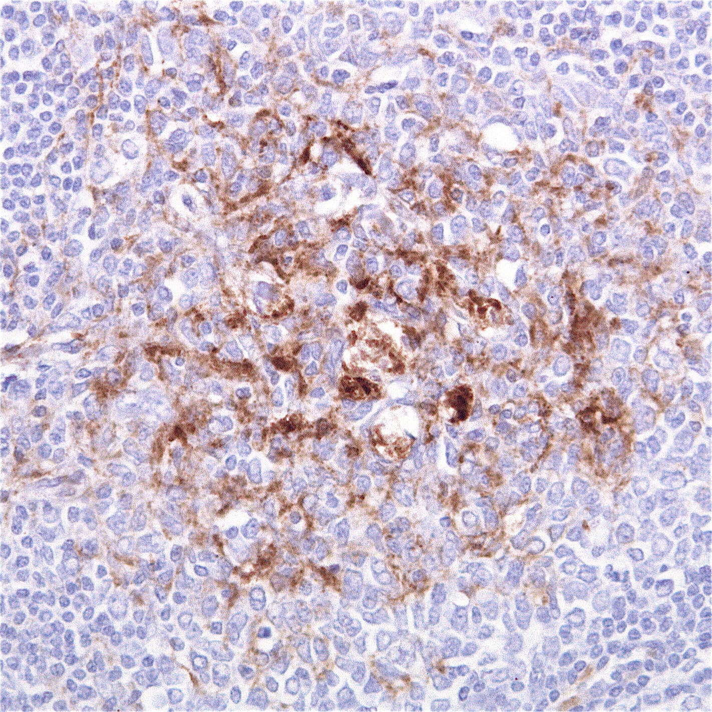 Prions in the Body and Creutzfeldt-Jakob Disease (CJD) Facts - Owlcation