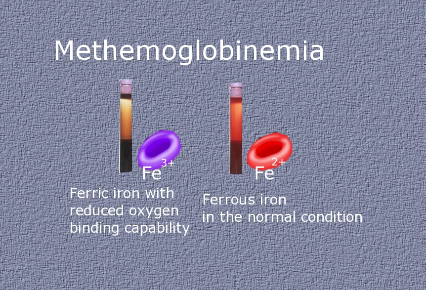 Blue People of Kentucky: Why the Fugate Family Had Blue Skin - Owlcation